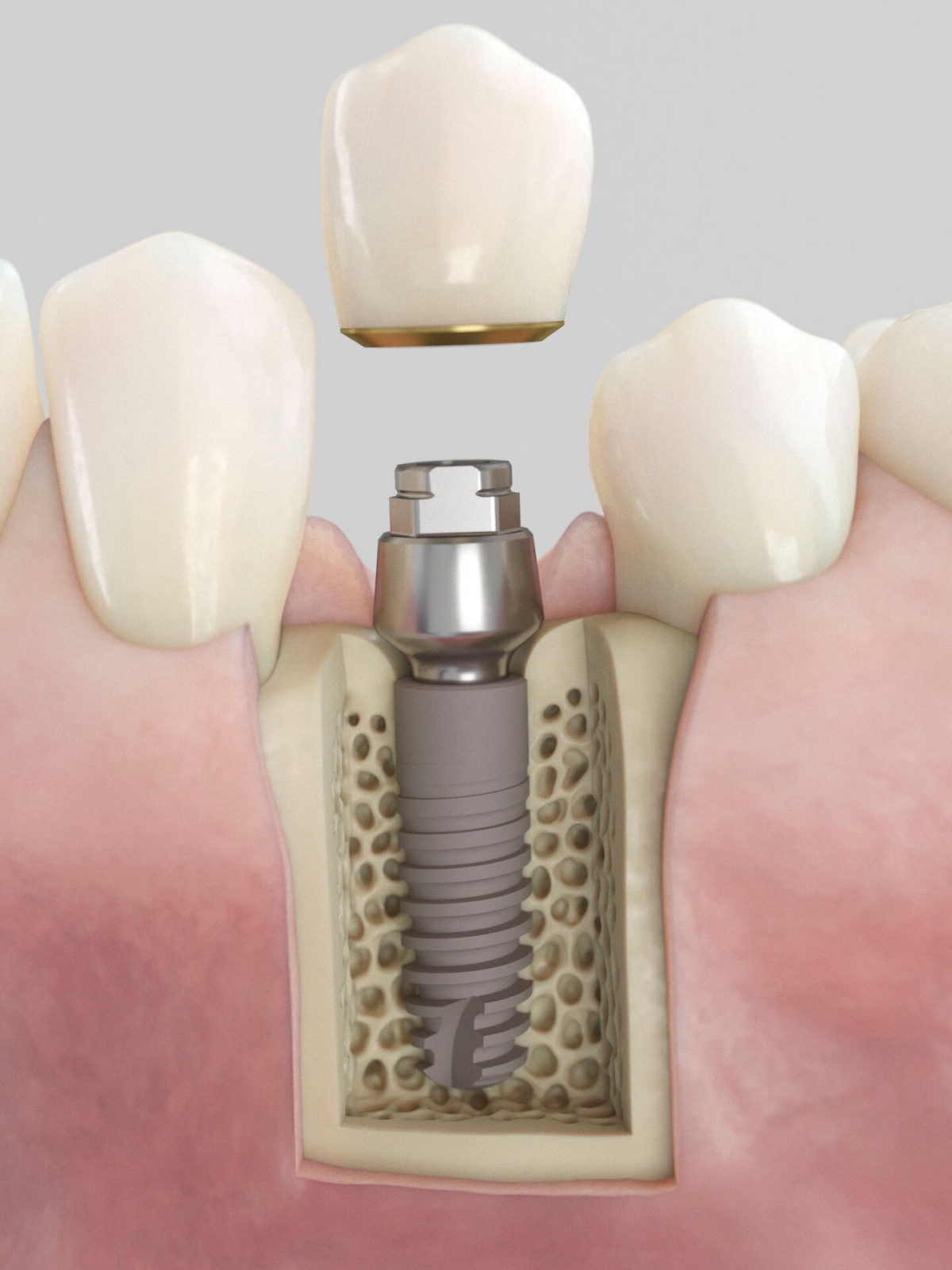 Making dreams come true—Dentsply Sirona Implants launches Acuris, the ...